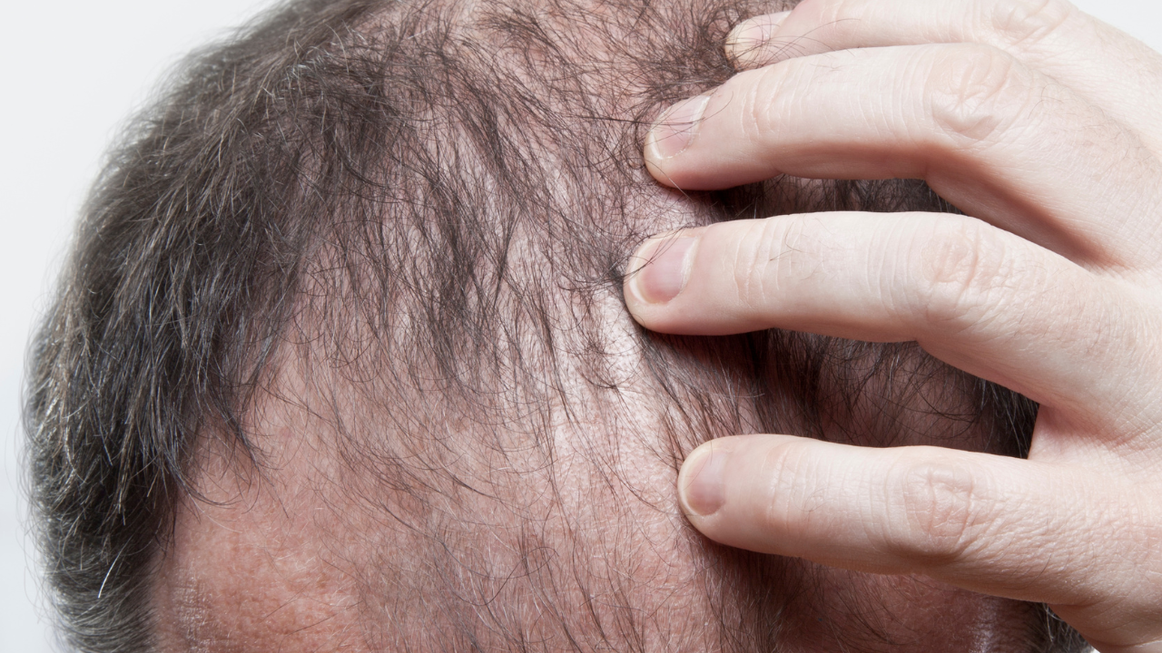 Regrowing Your Hair With Stinging Nettle Root A Natural Solution For